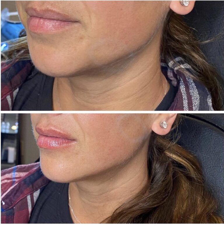 What is Jet Plasma and What Are The Benefits?