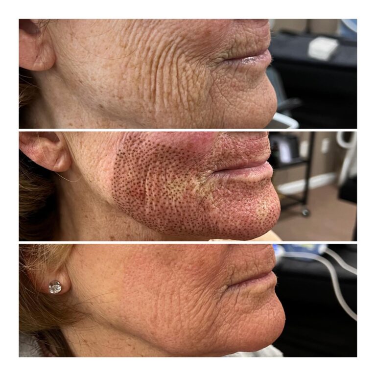 The Ultimate Guide to Plasma Fibroblast Anti-Aging Skin Treatment Aftercare