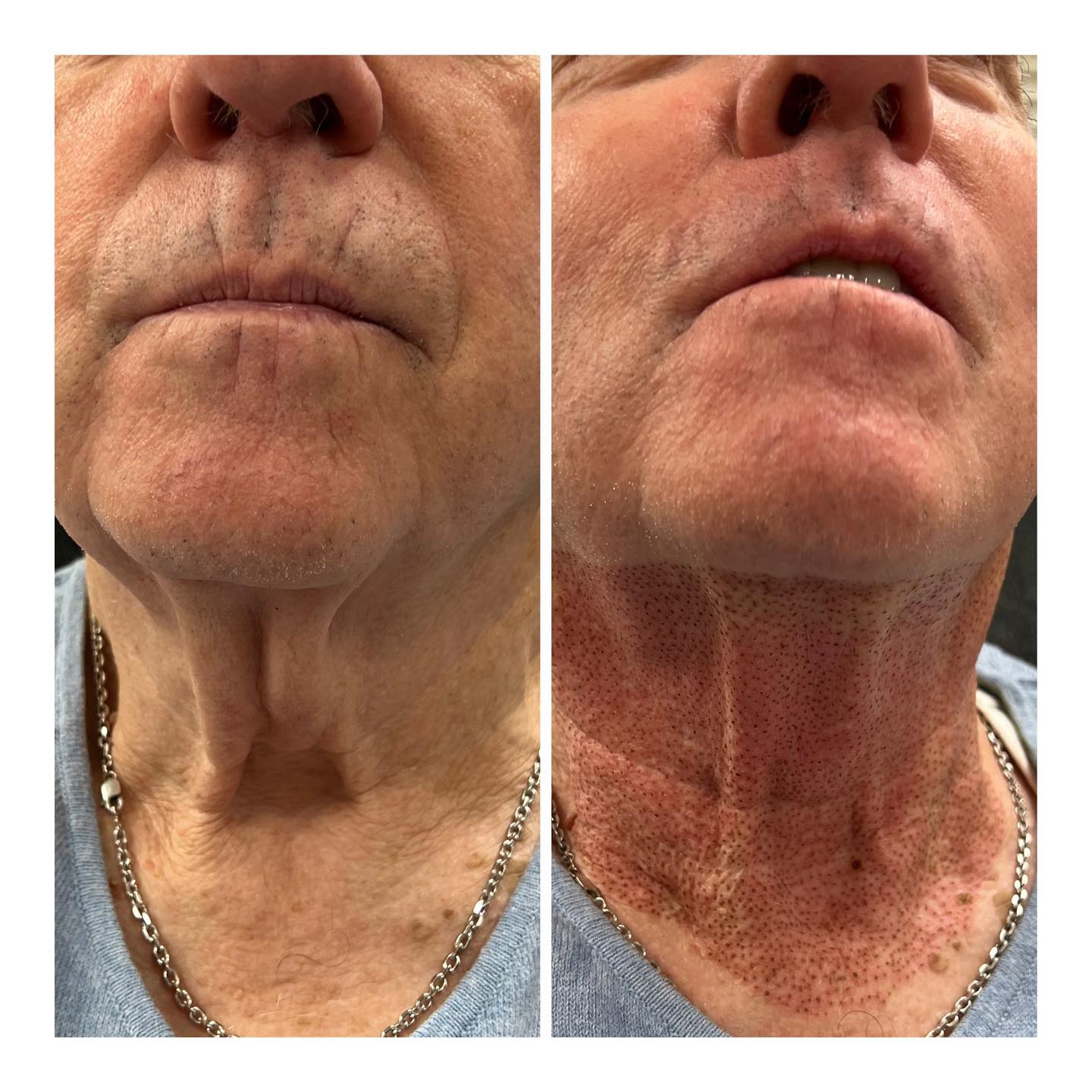 The Ultimate Guide to Plasma Fibroblast Anti-Aging Skin Treatment Aftercare