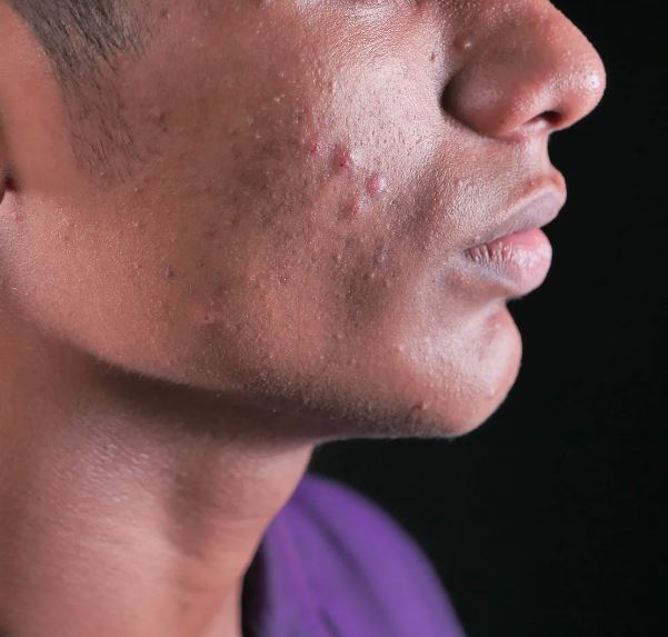 How Plasma Fibroblast Treatment Can Improve Acne Scars