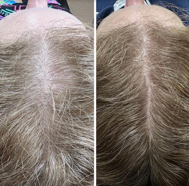 Unlock the Power of Jet Plasma and Microchanneling for fuller ...