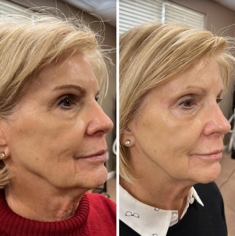 JET Plasma Skin Treatment Ocean County NJ Anti Aging