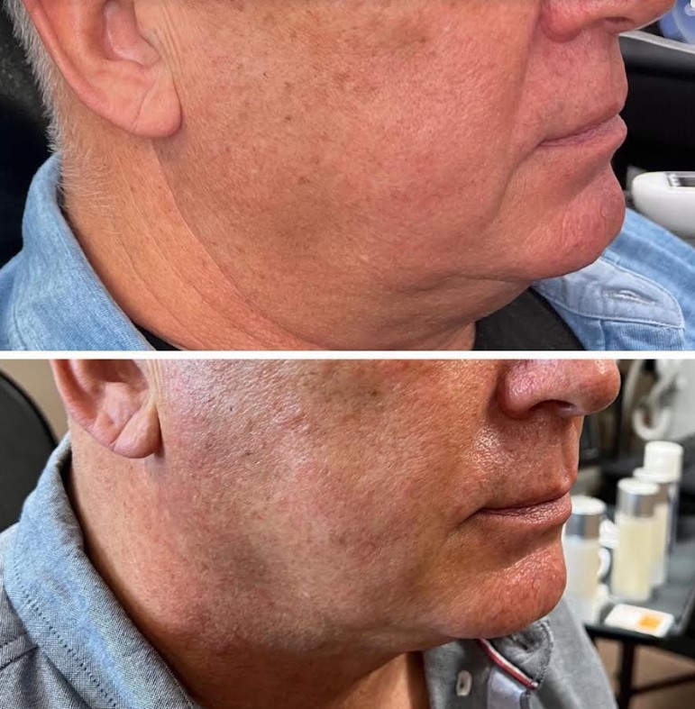 JET Plasma Skin Treatment Ocean County NJ Anti Aging